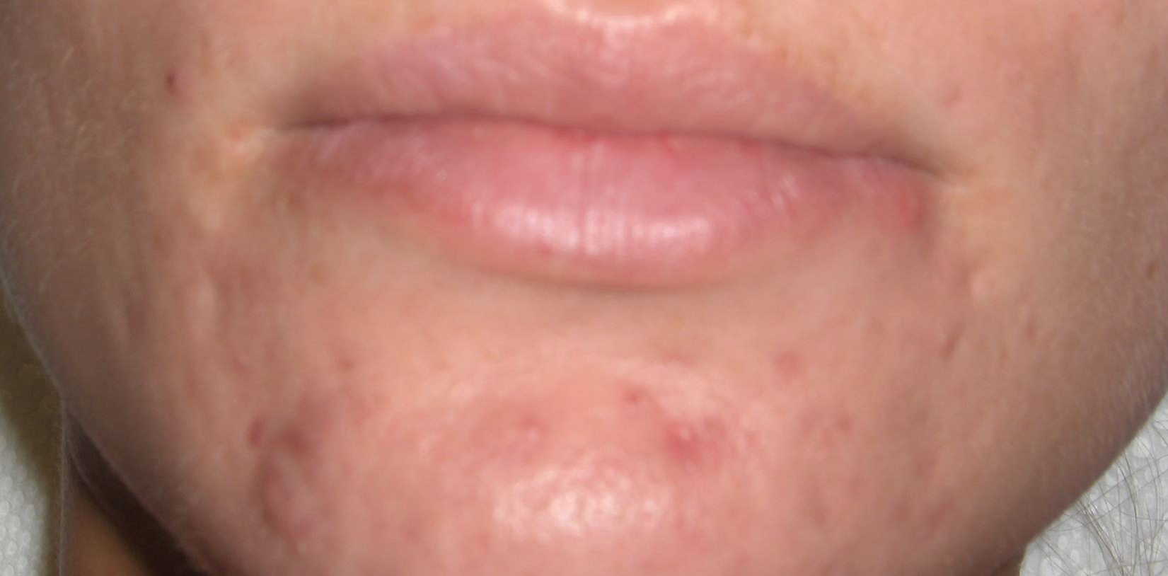 Acne Scarring